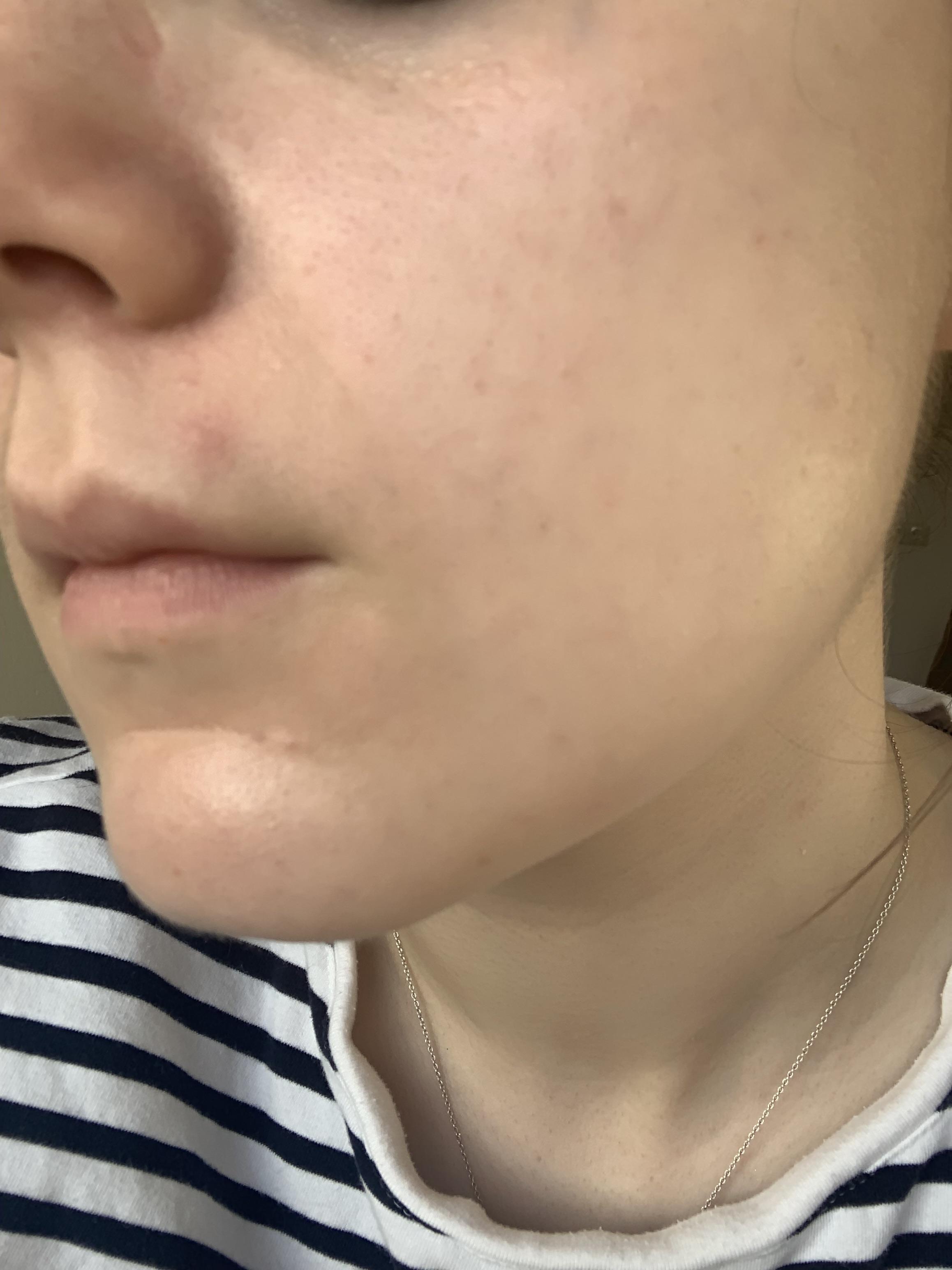 Help!!! how do i get rid of texture (oily skin) | Scrolller