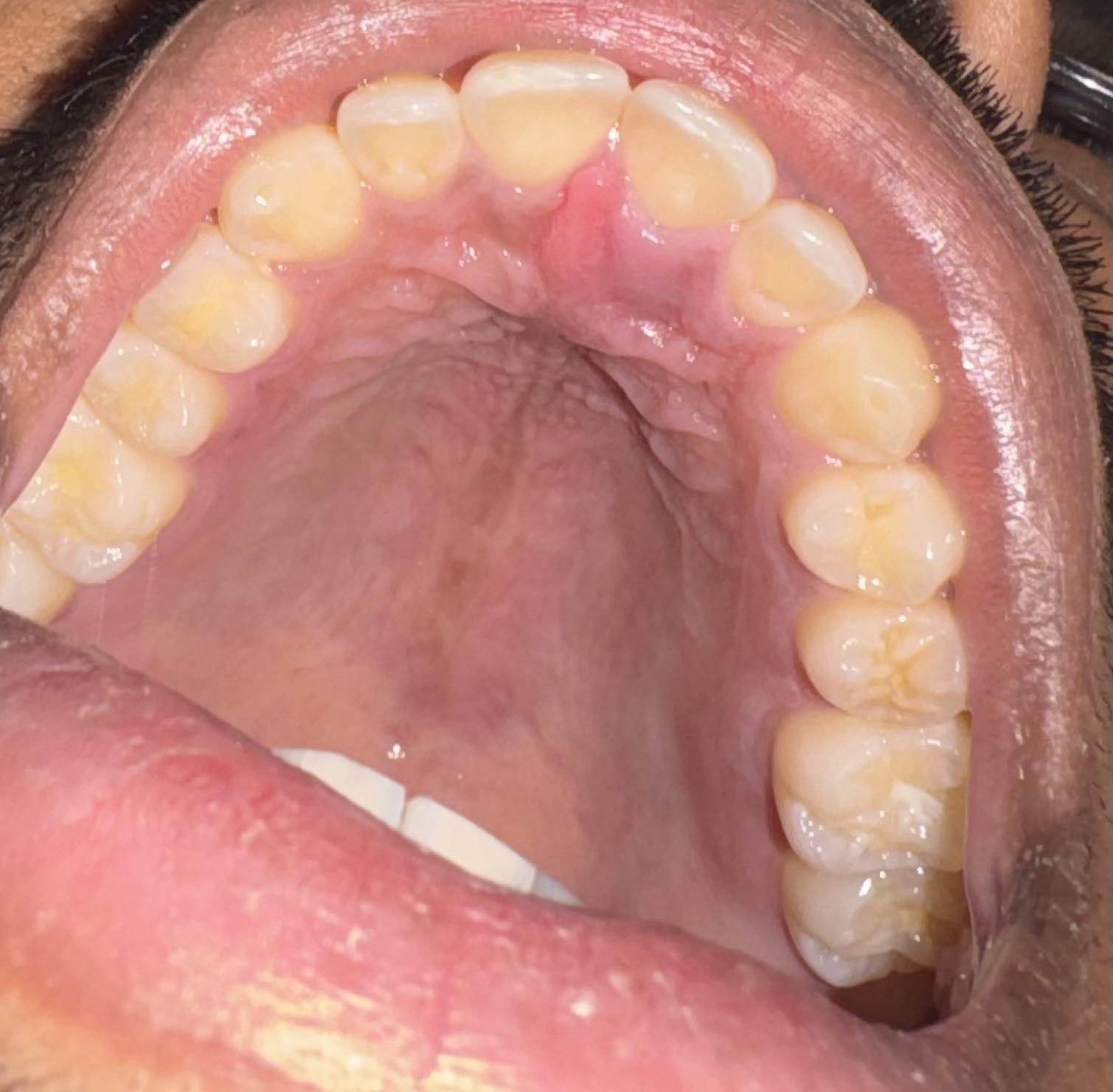 What is this random swelling on my gum? To see or not to see — my dentist? | Scrolller