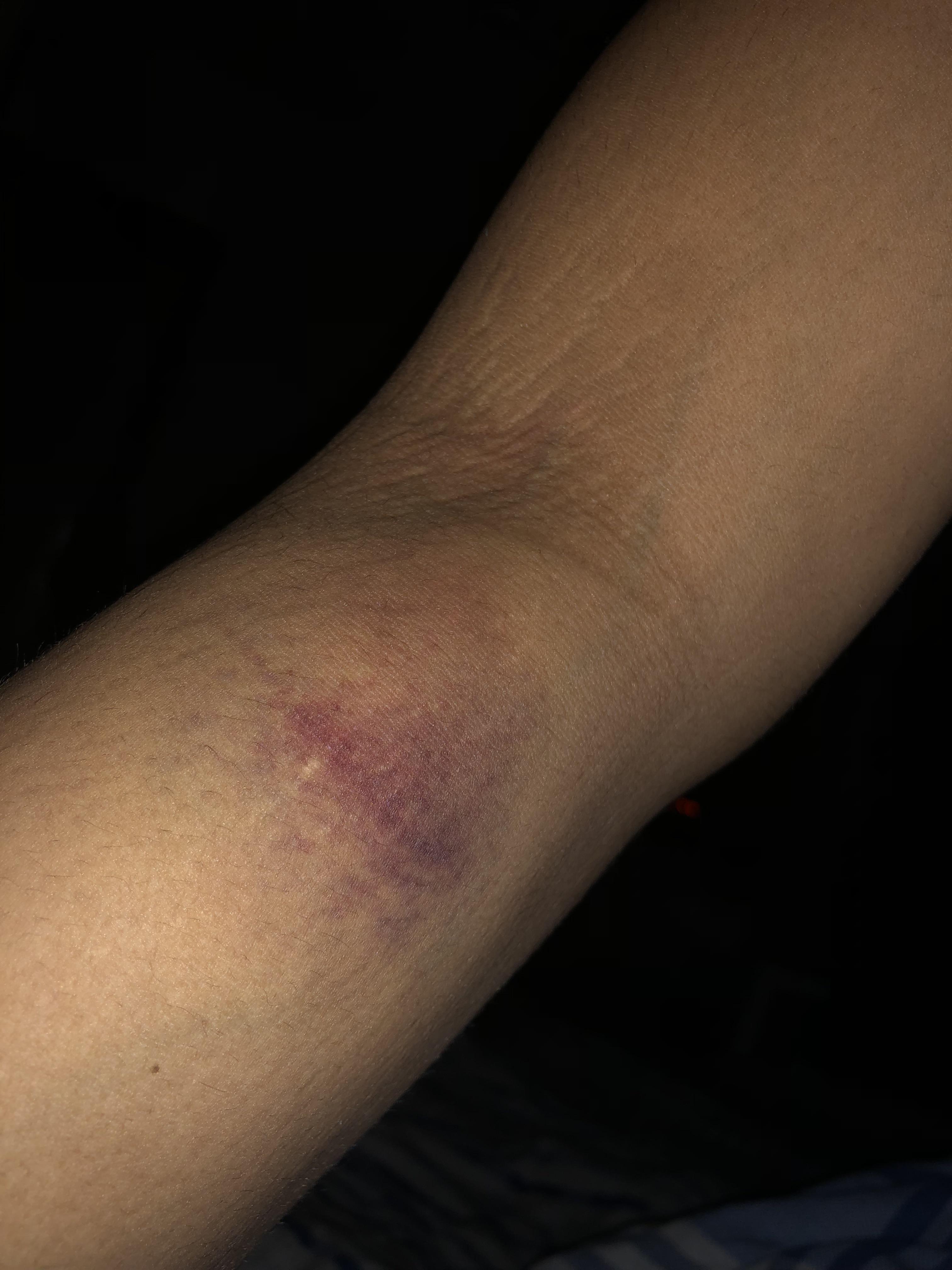 Random bruise on bicep after heavy concentration curls | Scrolller