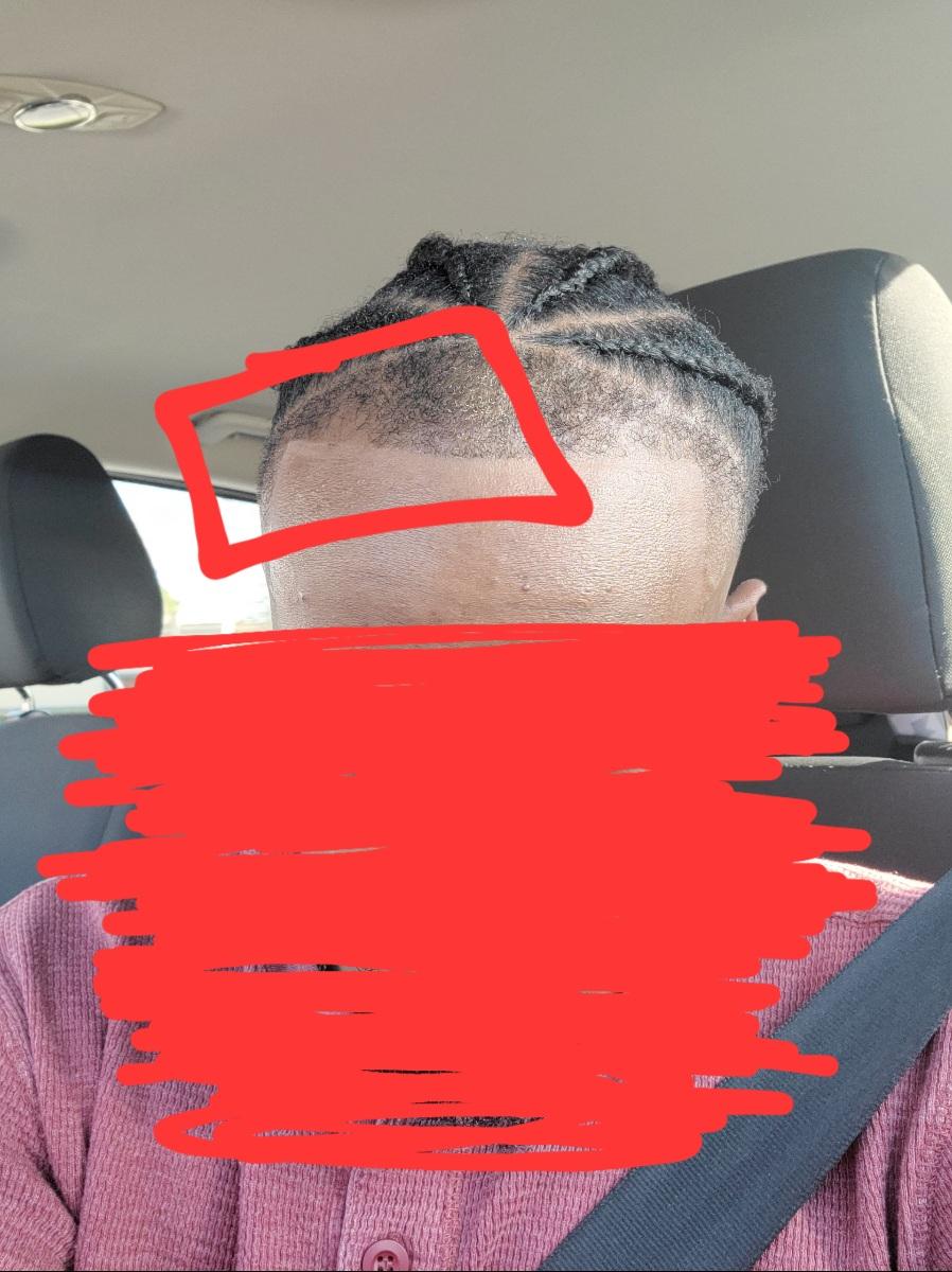 Traction Alopecia? | Scrolller