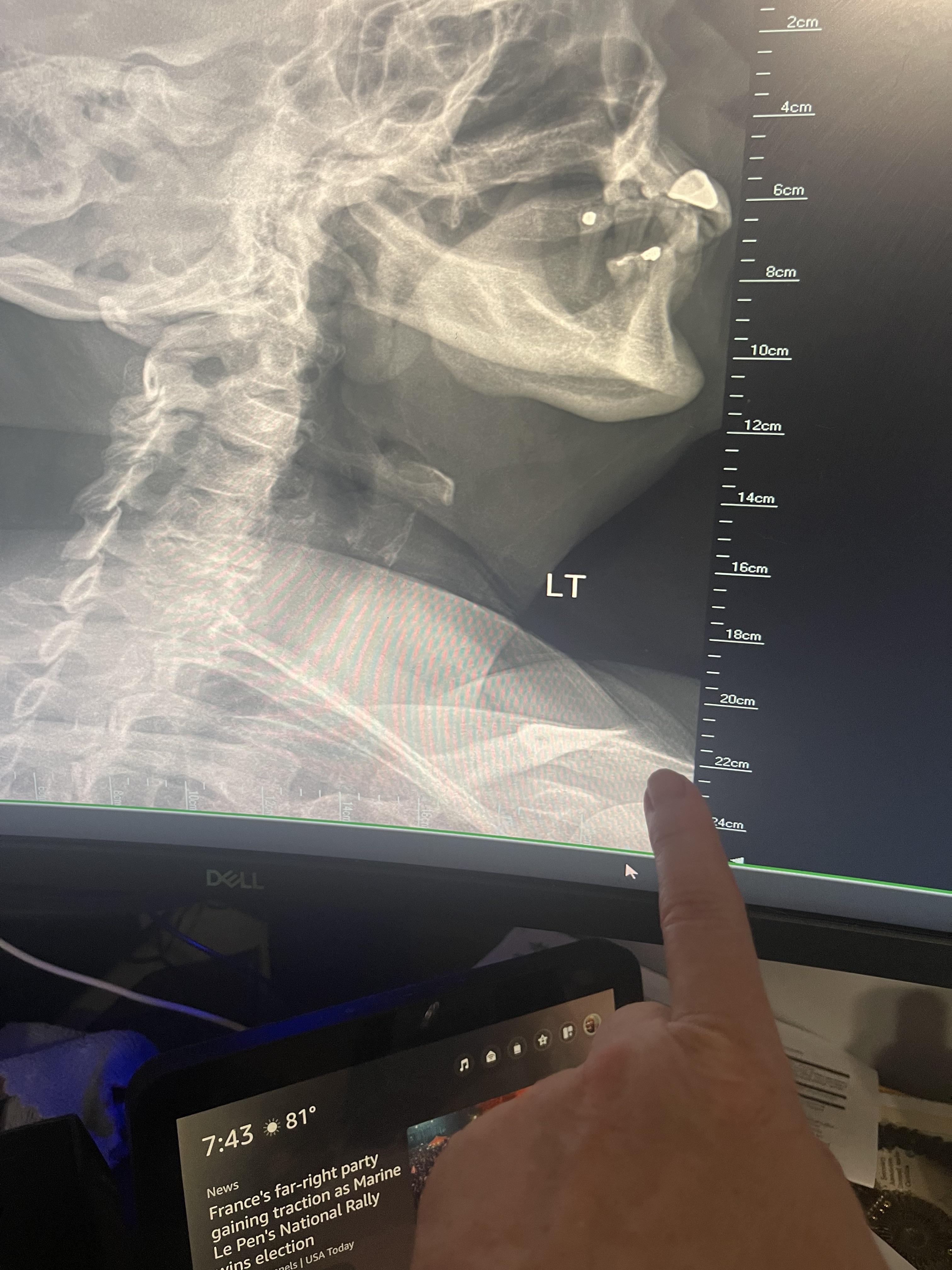 Is that a broken bone? | Scrolller