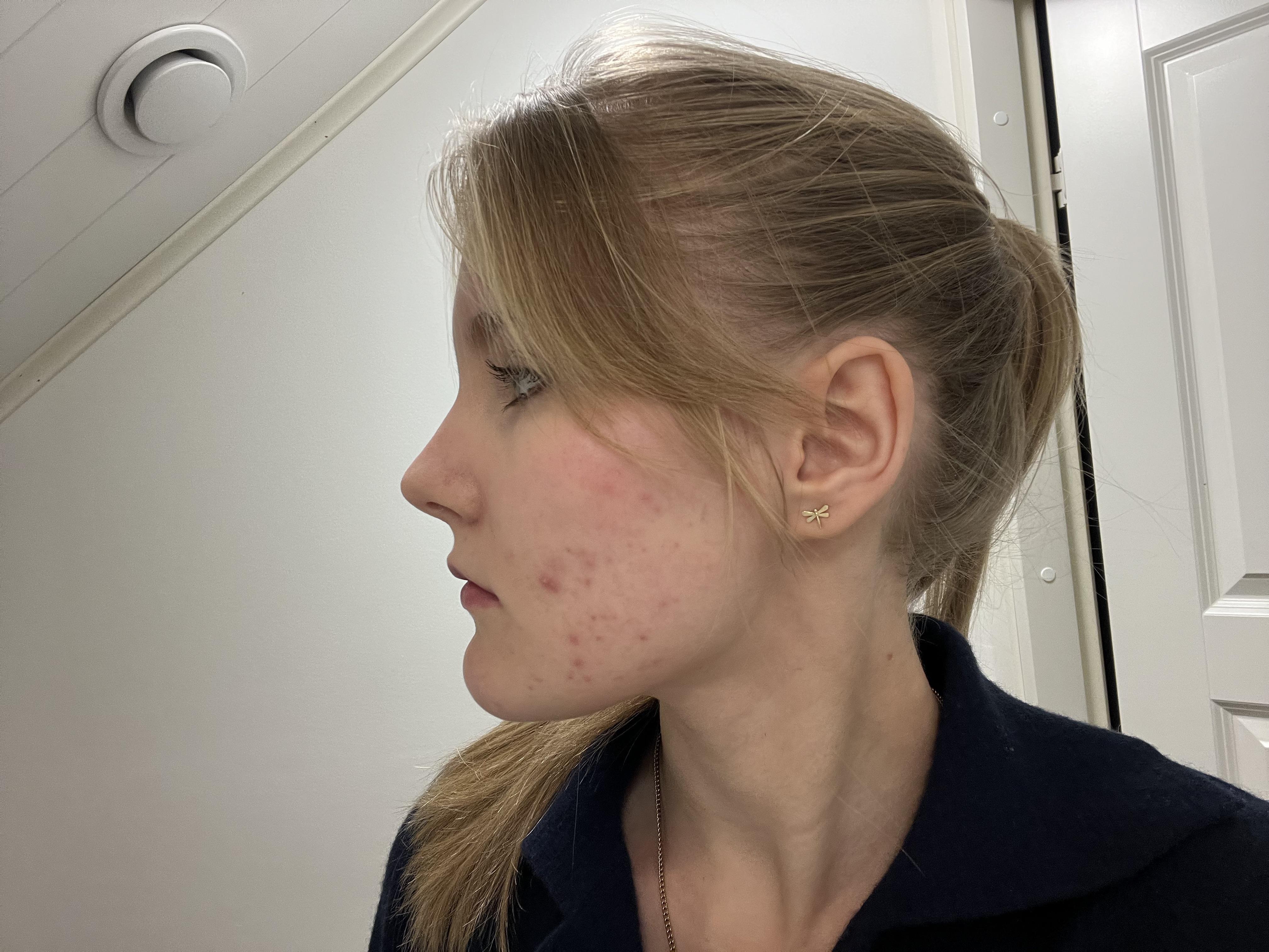 Help with hyperpigmentation/whatever this is on my cheeks | Scrolller